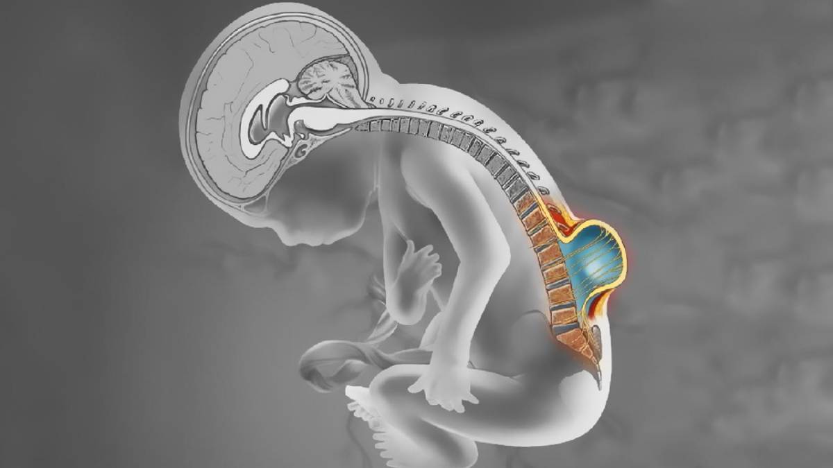 Spina Bifida: difetti cervicali non candidabili a chirurgia in utero